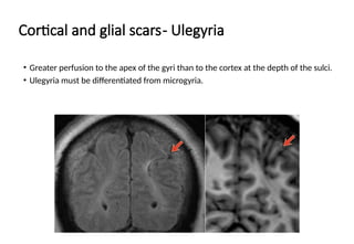 NEURORADIOLOGY EPILEPSY.pptx ppt on neuroradiology epilespsy | PPT
