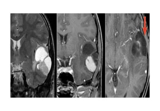 NEURORADIOLOGY EPILEPSY.pptx ppt on neuroradiology epilespsy | PPT