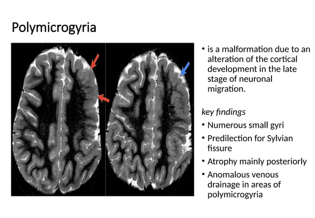 NEURORADIOLOGY EPILEPSY.pptx ppt on neuroradiology epilespsy | PPT