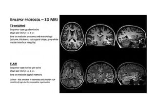 NEURORADIOLOGY EPILEPSY.pptx ppt on neuroradiology epilespsy | PPT