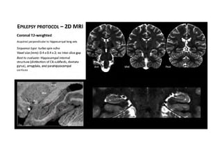 NEURORADIOLOGY EPILEPSY.pptx ppt on neuroradiology epilespsy | PPT