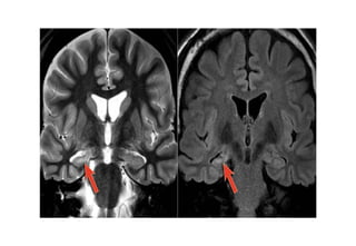 NEURORADIOLOGY EPILEPSY.pptx ppt on neuroradiology epilespsy | PPT