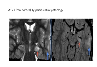 NEURORADIOLOGY EPILEPSY.pptx ppt on neuroradiology epilespsy | PPT
