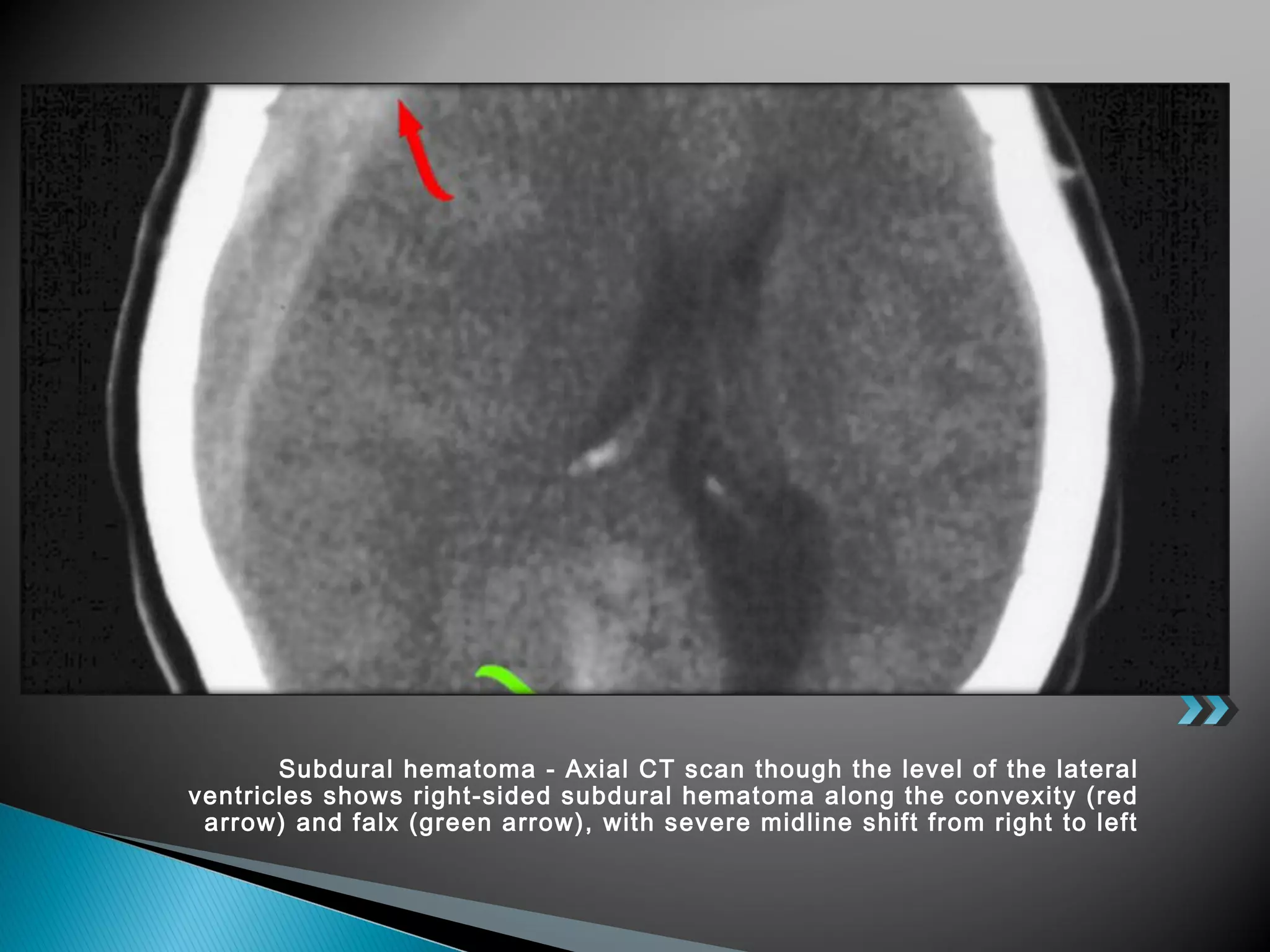 Neuroradiology head trauma | PPT