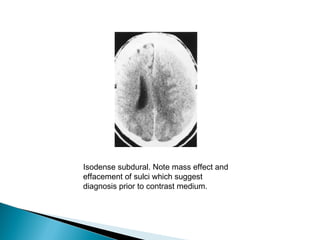Neuroradiology head trauma | PPT