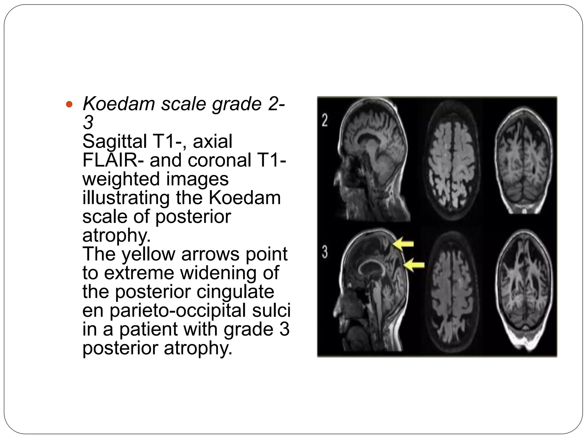 Neuroradiology in dementia | PPTX