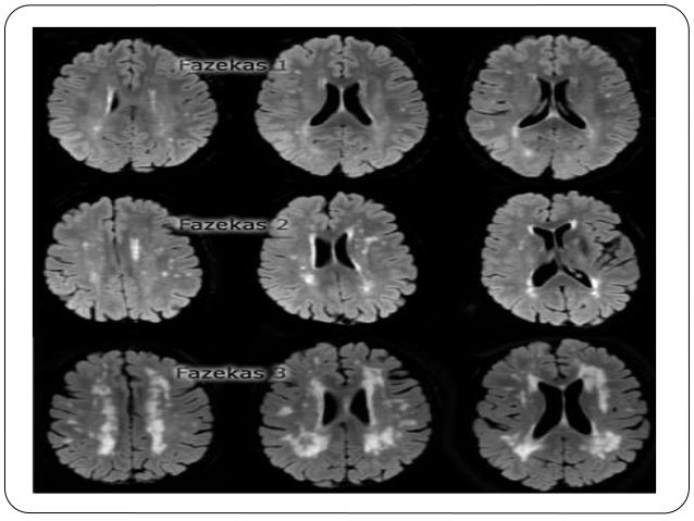 Neuroradiology in dementia