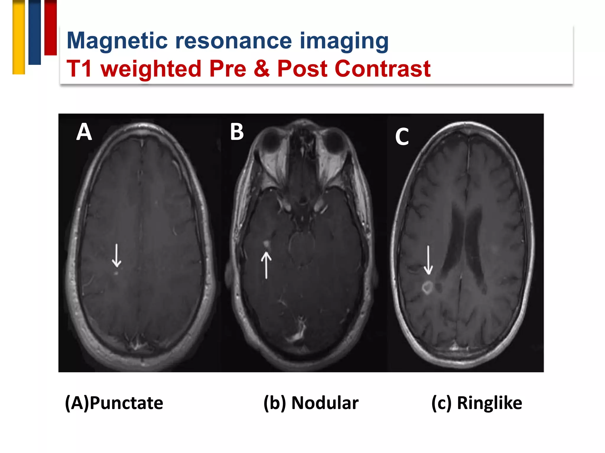 Neuroradiology in ms | PDF