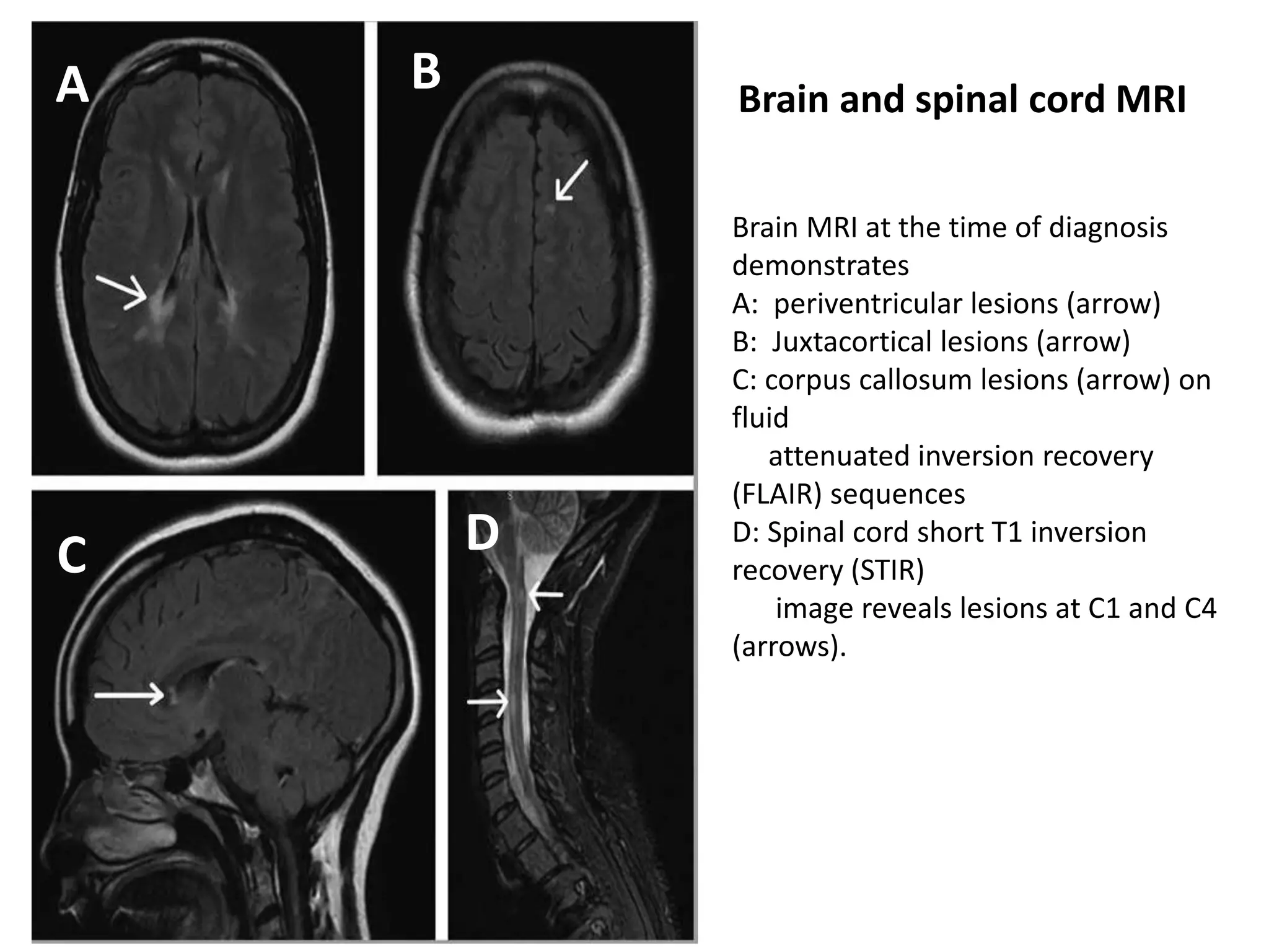 Neuroradiology in ms | PDF