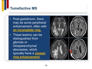 Neuroradiology in ms | PDF