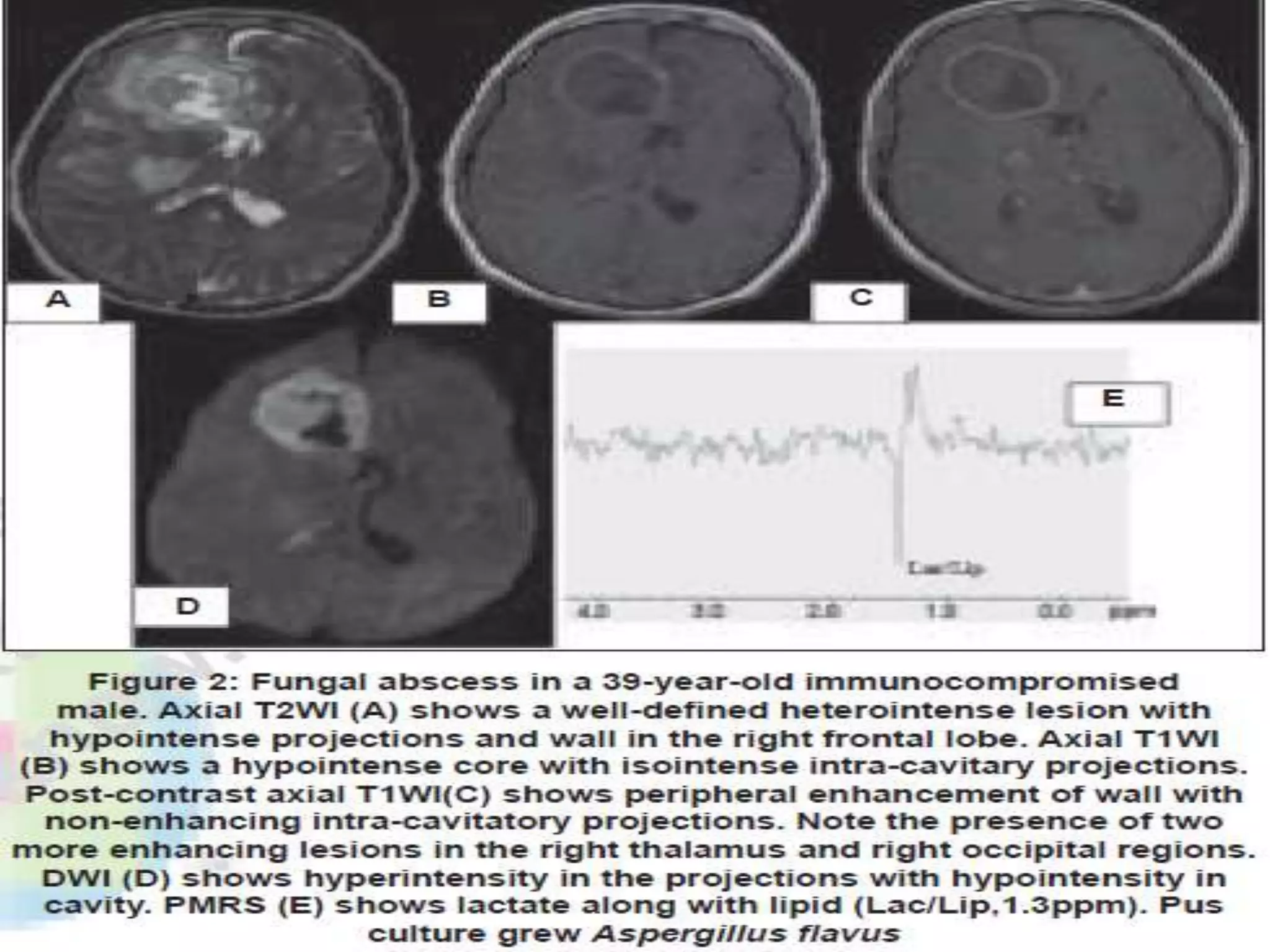 Neuroradiology of cns funfal infections | PPTX