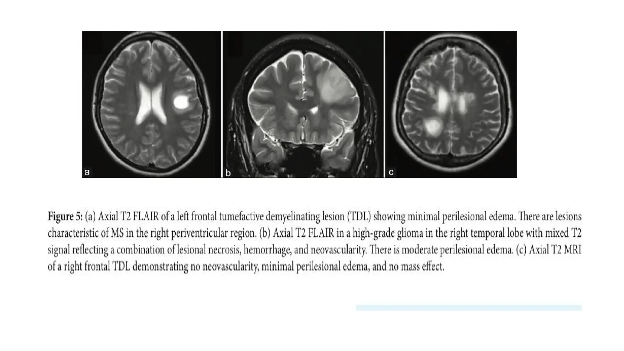 NEURORADIOLOGY tumefactive demyelination.pptx