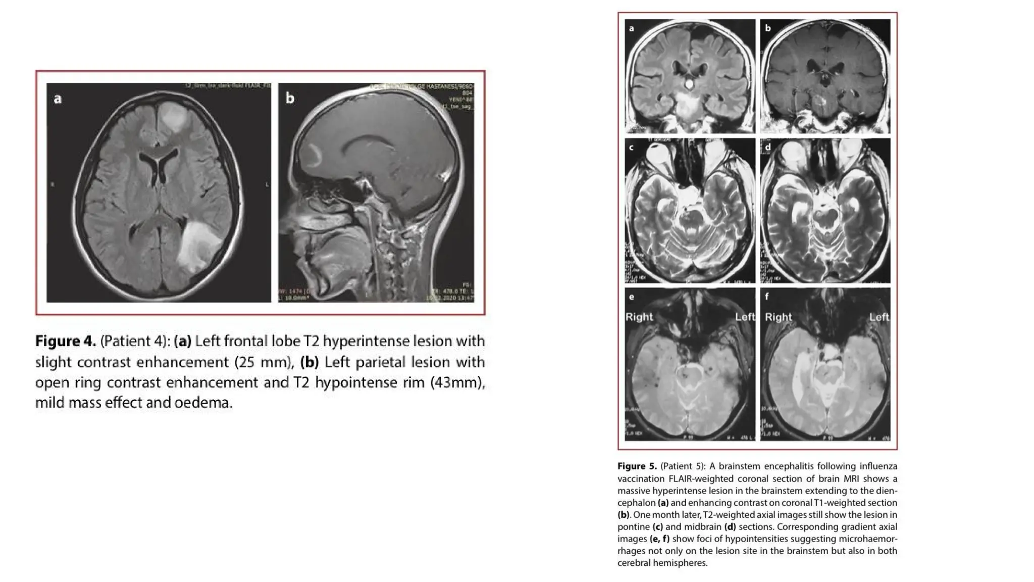 NEURORADIOLOGY tumefactive demyelination.pptx
