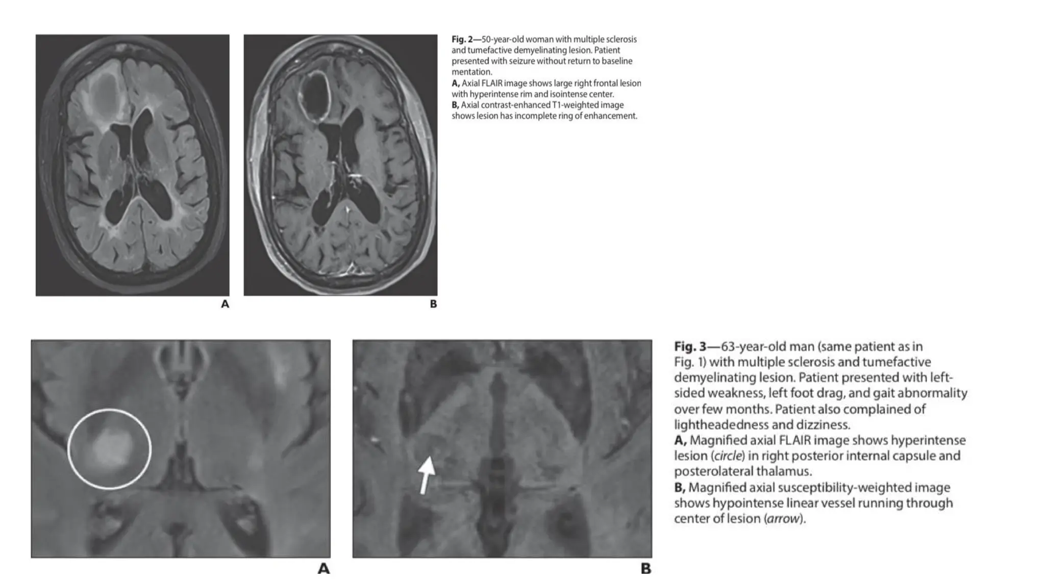 NEURORADIOLOGY tumefactive demyelination.pptx
