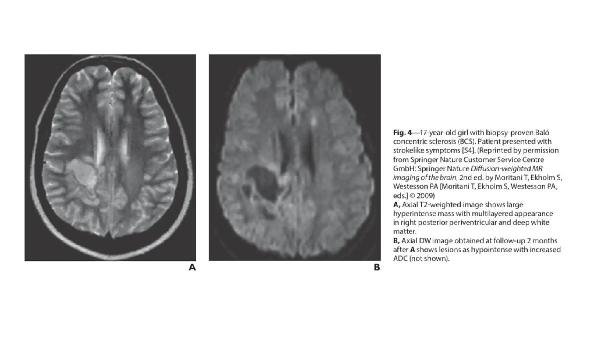 NEURORADIOLOGY tumefactive demyelination.pptx