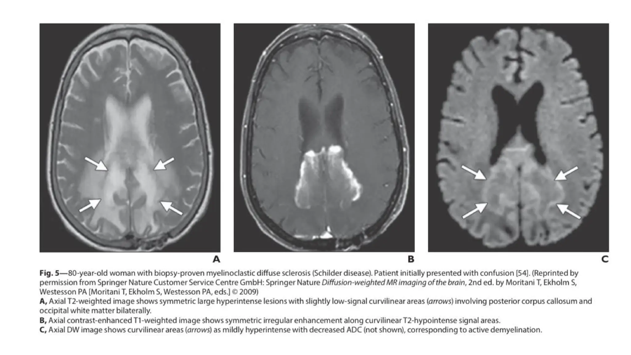 NEURORADIOLOGY tumefactive demyelination.pptx