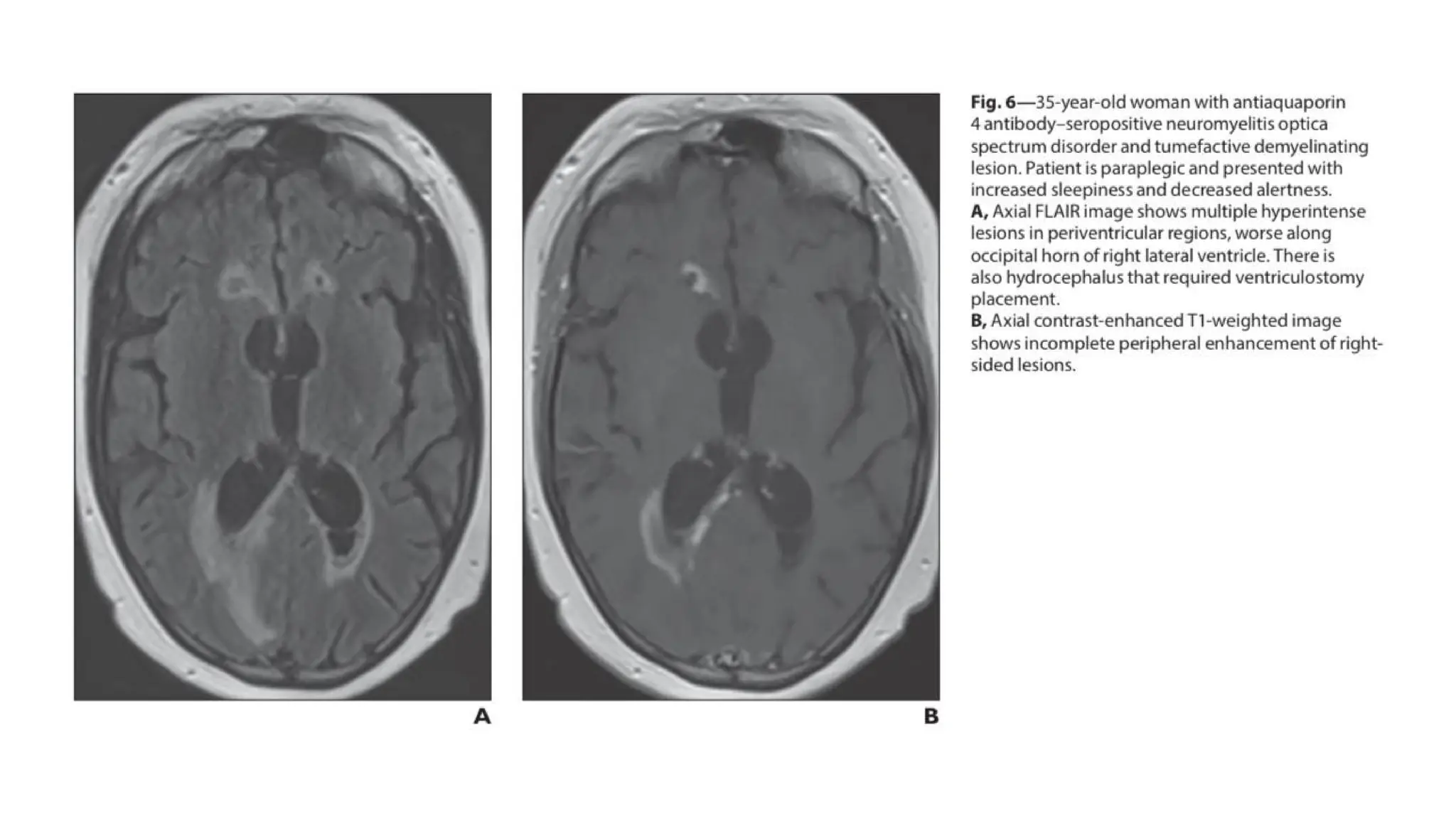 NEURORADIOLOGY tumefactive demyelination.pptx