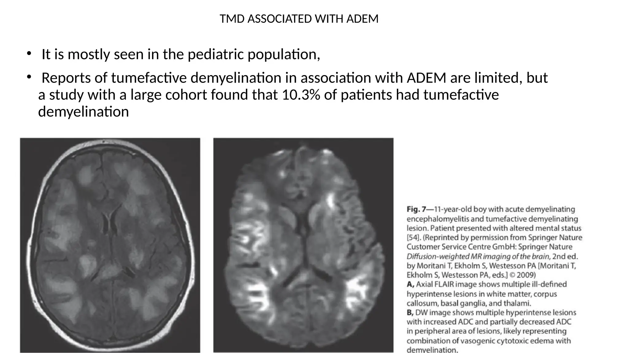 NEURORADIOLOGY tumefactive demyelination.pptx