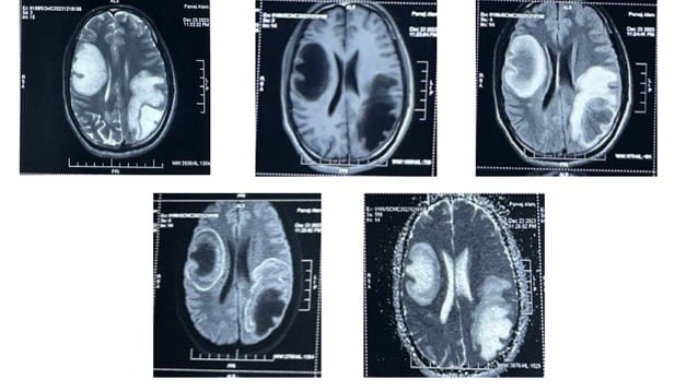NEURORADIOLOGY tumefactive demyelination.pptx