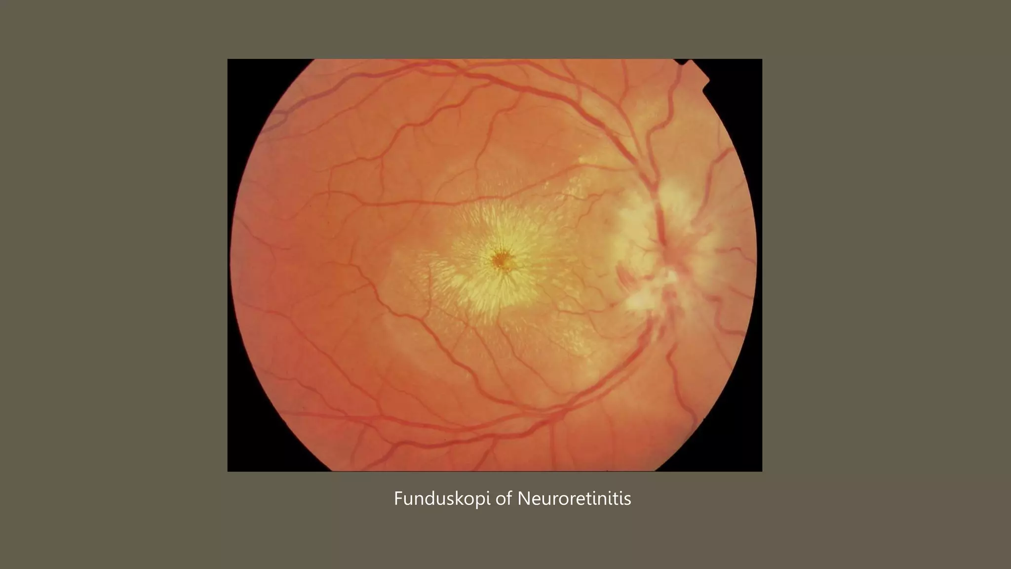 Neuroretinitis.pptx