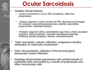 Neurosarcoidosis | PPT