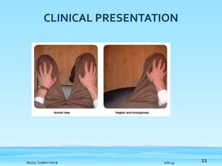 Post stroke hemispatial neglect syndrome | PPTX