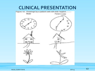 Post stroke hemispatial neglect syndrome | PPTX