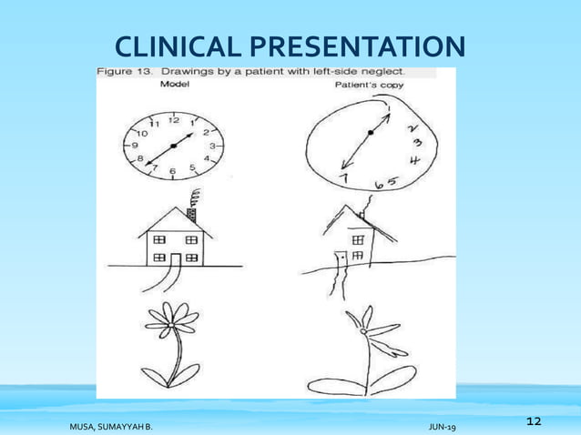 Post stroke hemispatial neglect syndrome | PPTX | Brain and Nervous ...
