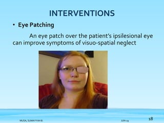 Post stroke hemispatial neglect syndrome | PPTX