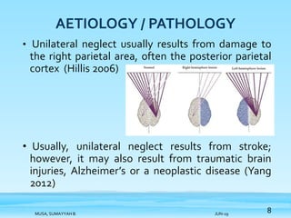 Post stroke hemispatial neglect syndrome | PPTX | Brain and Nervous ...