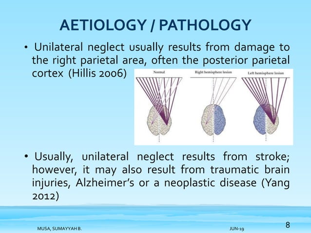 Post stroke hemispatial neglect syndrome | PPTX | Brain and Nervous ...