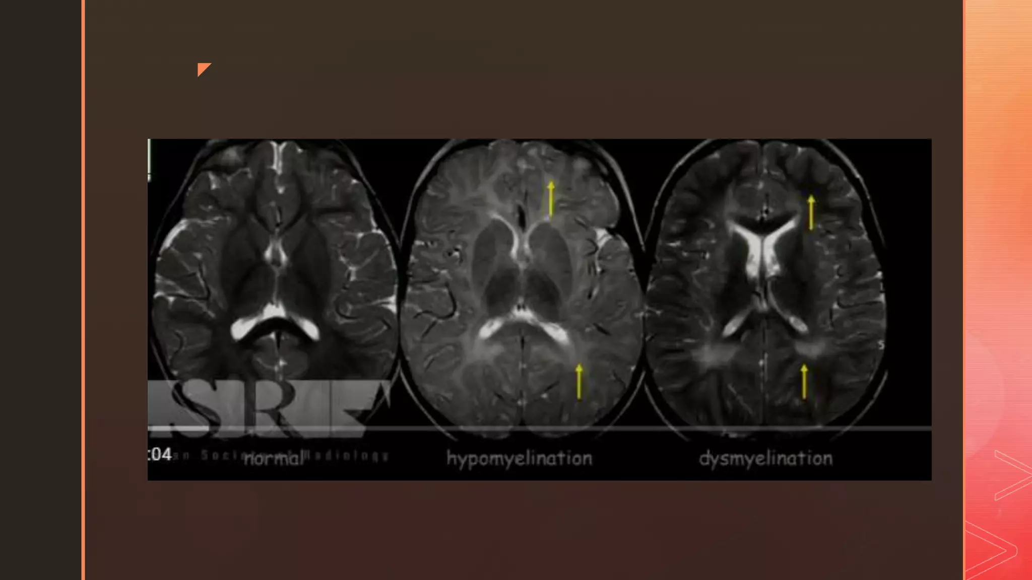 Neuro signs | PPTX