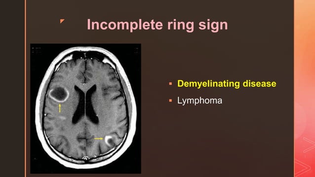 Neuro signs | PPTX | Brain and Nervous System Disorders | Diseases and ...
