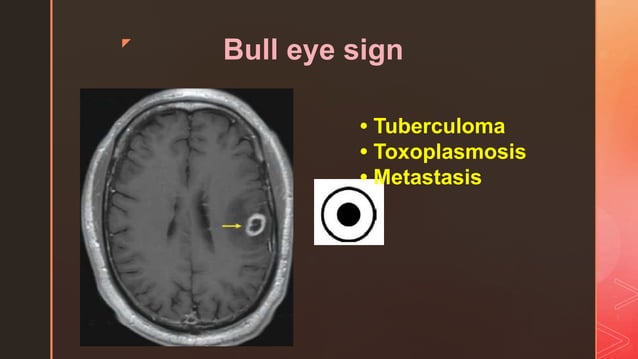 Neuro signs | PPTX | Brain and Nervous System Disorders | Diseases and ...