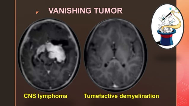 Neuro signs | PPTX | Brain and Nervous System Disorders | Diseases and ...