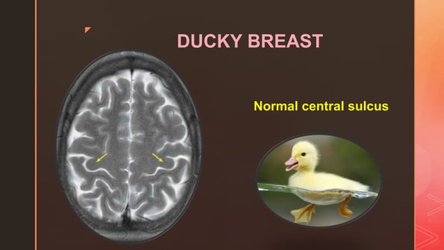 Neuro signs | PPTX | Brain and Nervous System Disorders | Diseases and ...