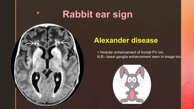 Neuro signs | PPTX | Brain and Nervous System Disorders | Diseases and ...