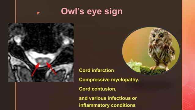 Neuro signs | PPTX | Brain and Nervous System Disorders | Diseases and ...