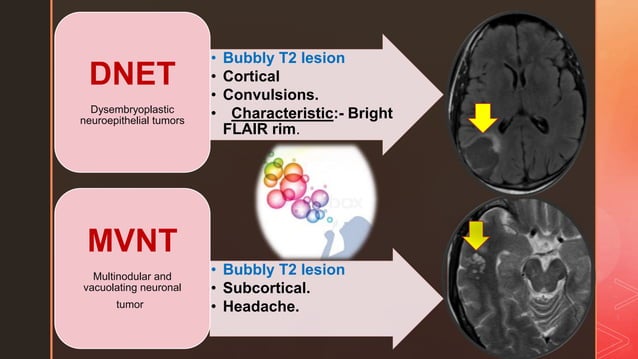 Neuro signs | PPTX | Brain and Nervous System Disorders | Diseases and ...