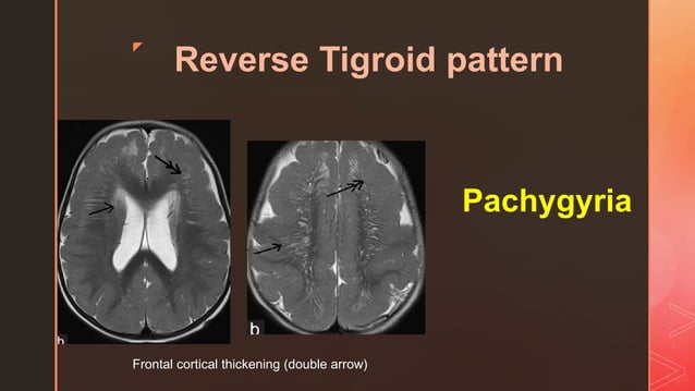 Neuro signs | PPTX | Brain and Nervous System Disorders | Diseases and ...