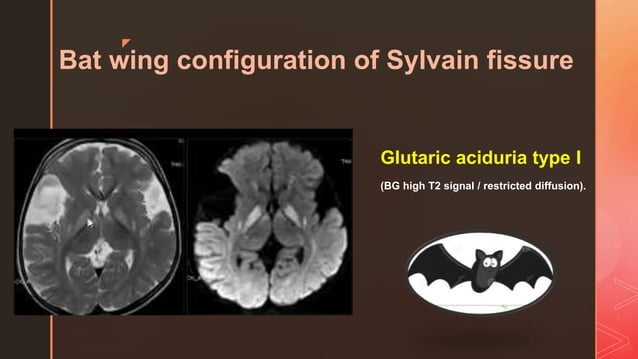 Neuro signs | PPTX | Brain and Nervous System Disorders | Diseases and ...