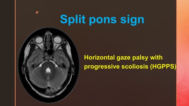 Neuro signs | PPTX | Brain and Nervous System Disorders | Diseases and ...