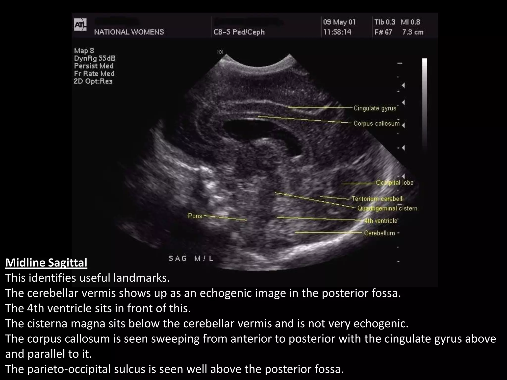Neurosonogram.. Dr.Padmesh | PPTX