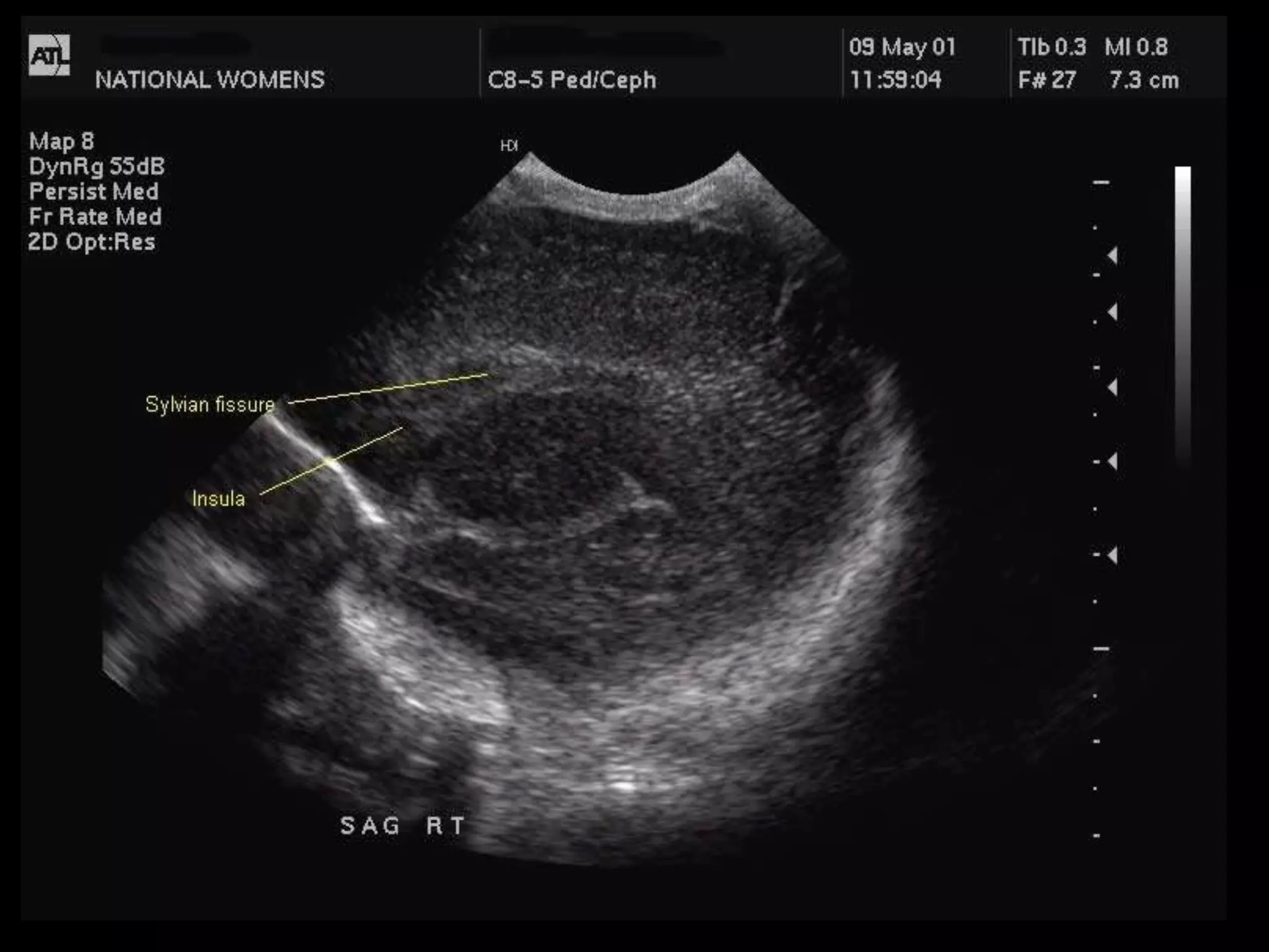 Neurosonogram.. Dr.Padmesh | PPTX