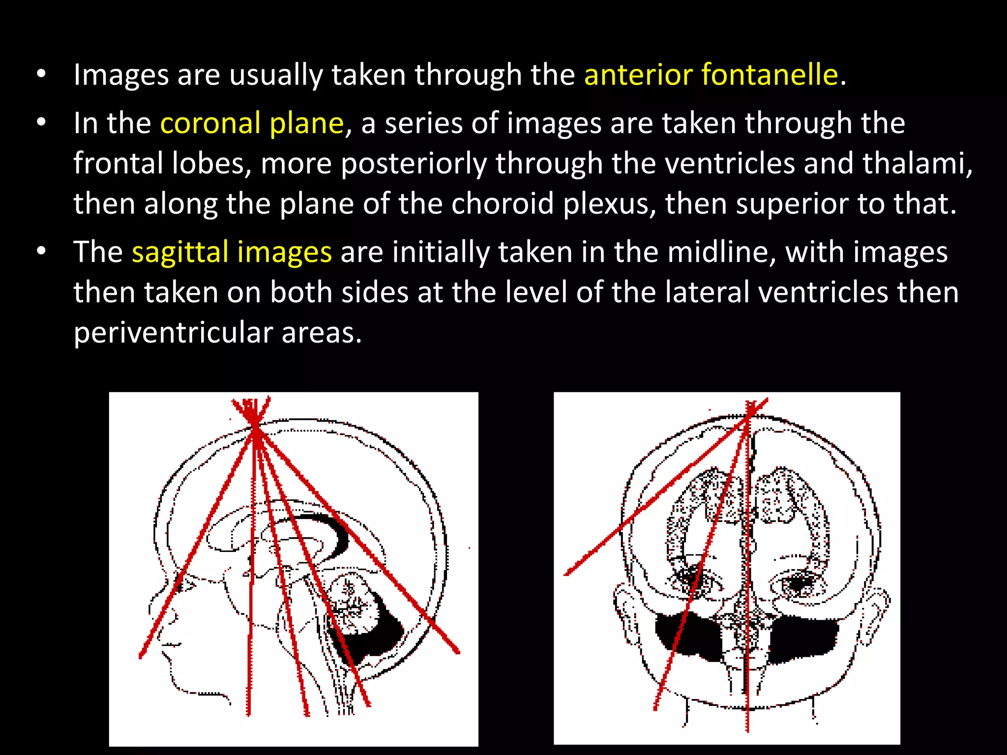 Neurosonogram.. Dr.Padmesh | PPTX