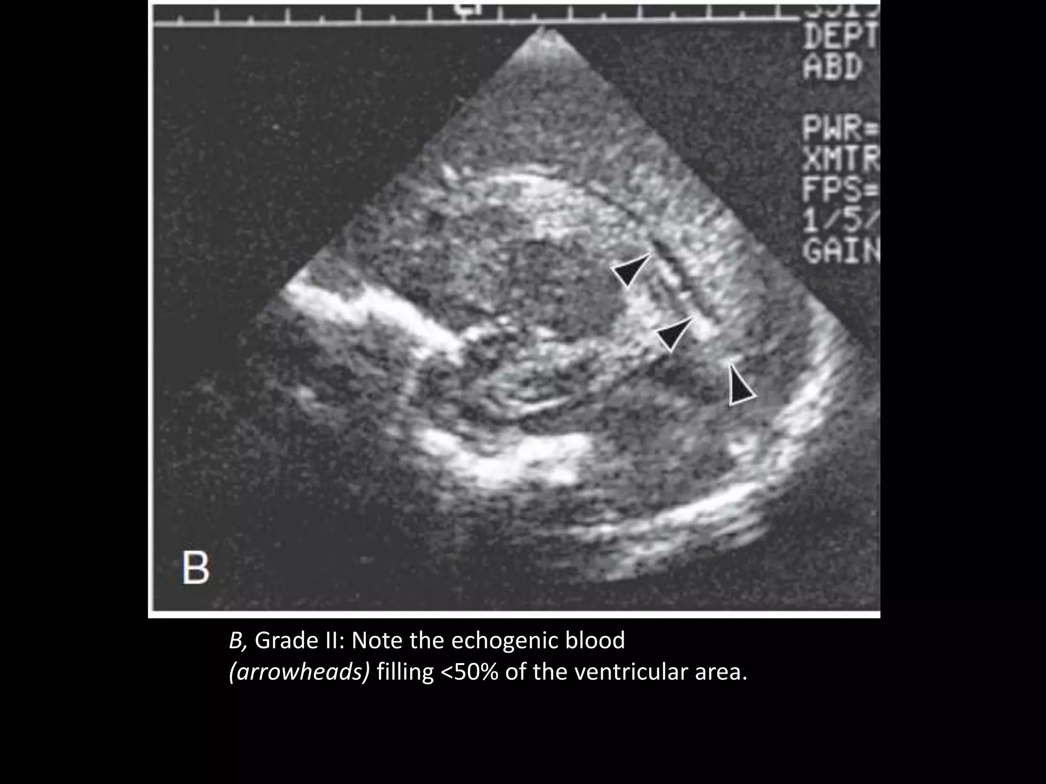 Neurosonogram.. Dr.Padmesh | PPTX