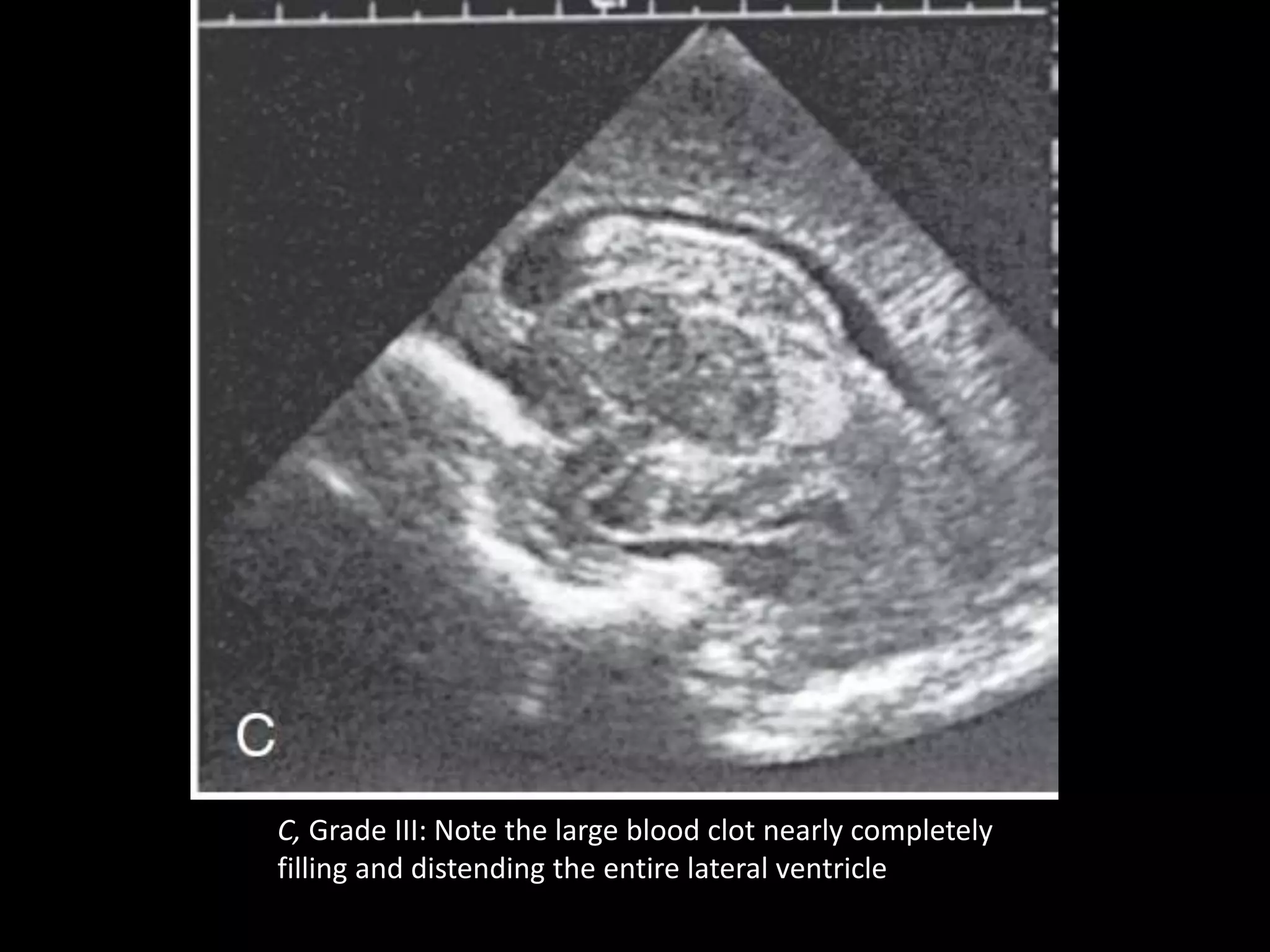 Neurosonogram.. Dr.Padmesh | PPTX