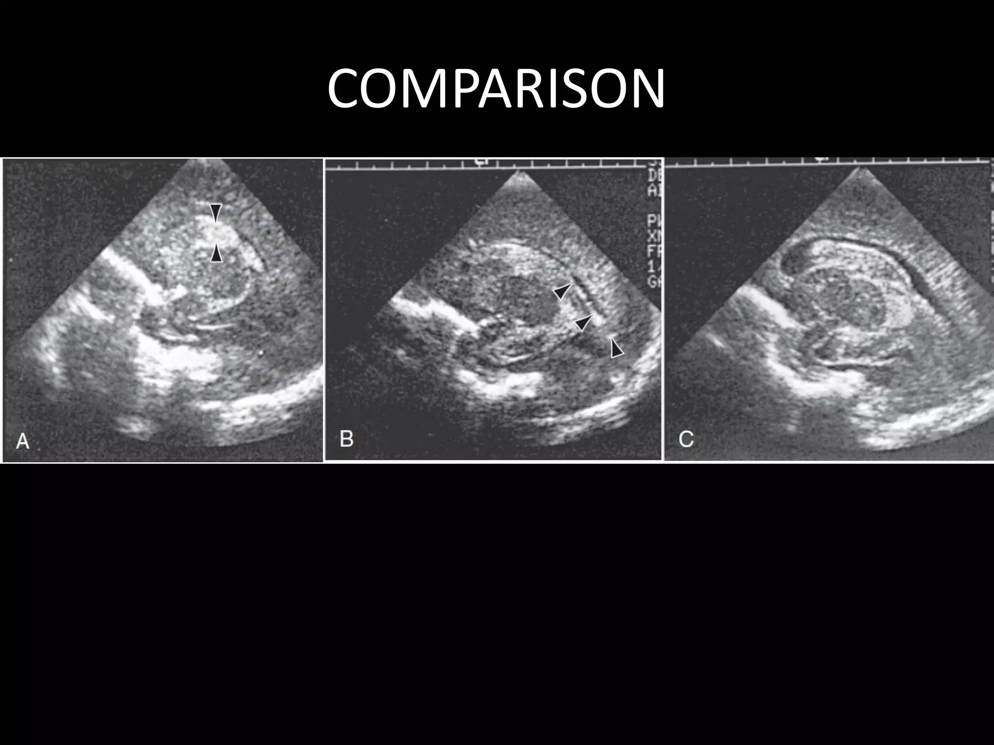 Neurosonogram.. Dr.Padmesh | PPTX