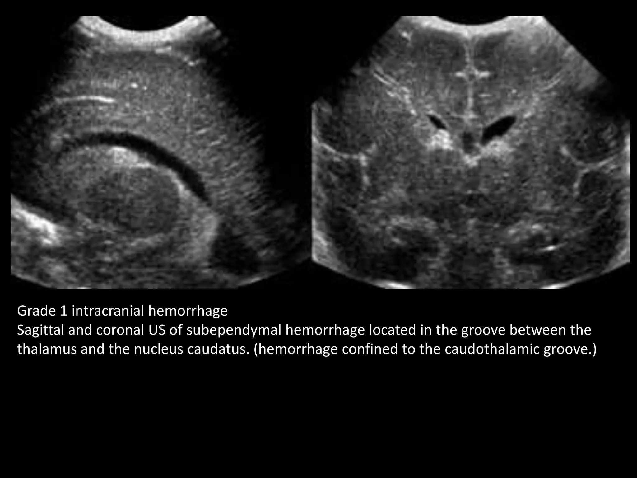 Neurosonogram.. Dr.Padmesh | PPTX
