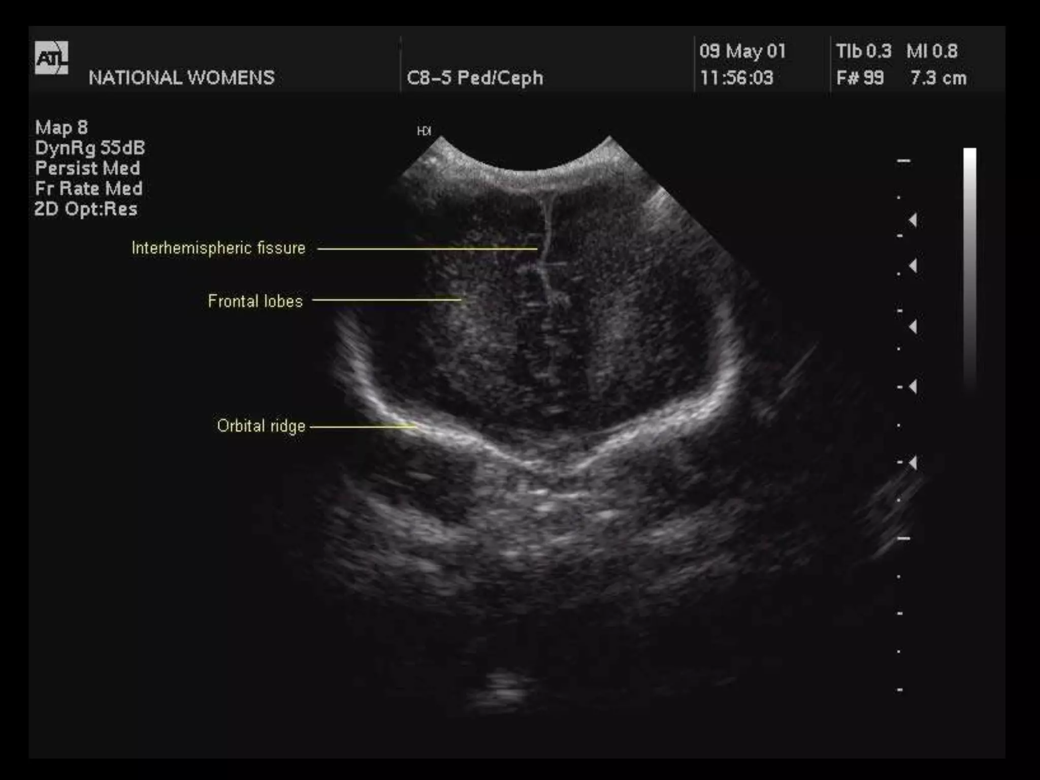 Neurosonogram.. Dr.Padmesh | PPTX
